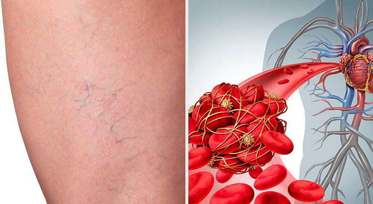 Phlebitis: Causes, Symptoms and Treatment | Best Herbal Health